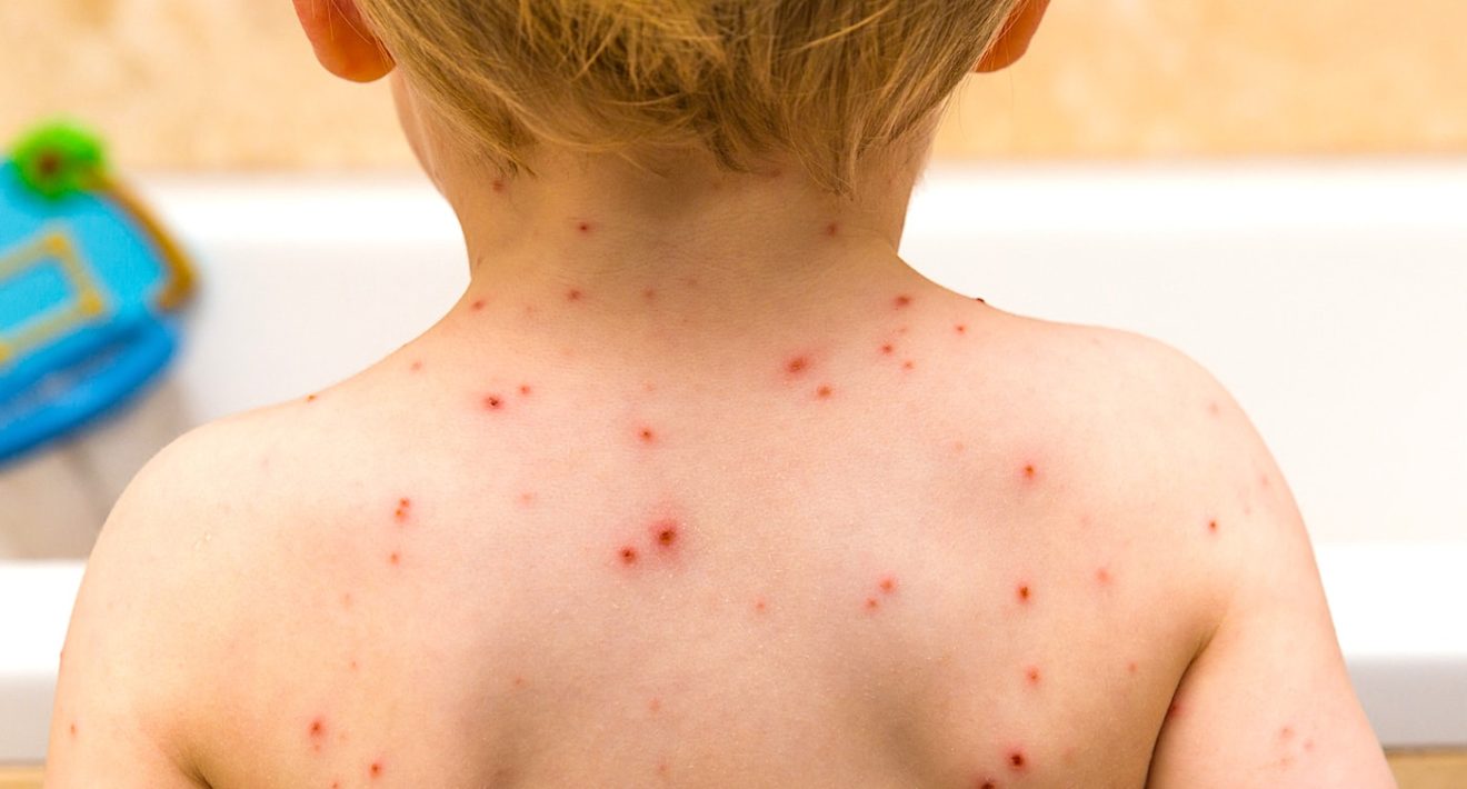 La plus grande épidémie de varicelle voit le jour dans une communauté ...
