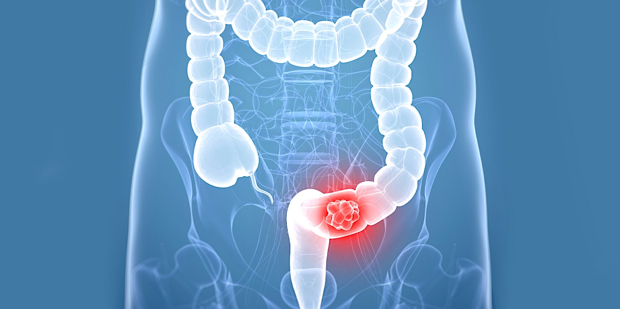 Une nouvelle cible thérapeutique prometteuse pour traiter 80% des ...
