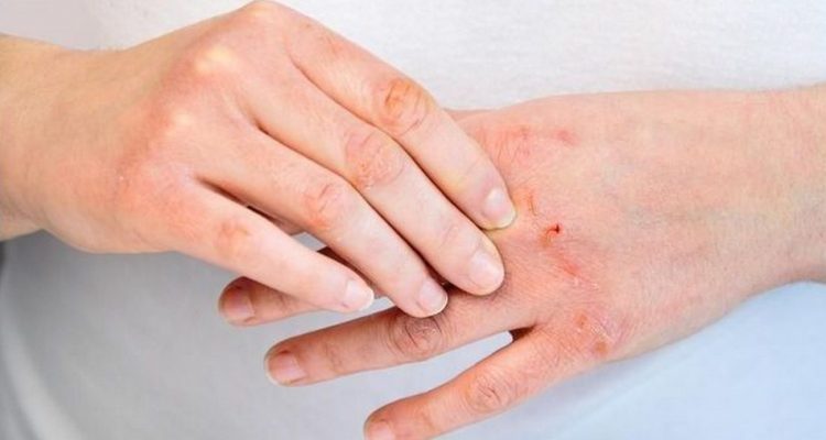 Eczéma : des chercheurs identifient des facteurs clés à l'origine cette ...