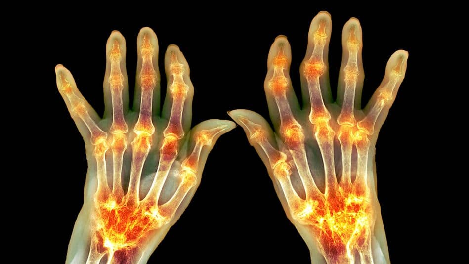 Polyarthrite rhumatoïde : nouvel espoir de traitement suite à la ...