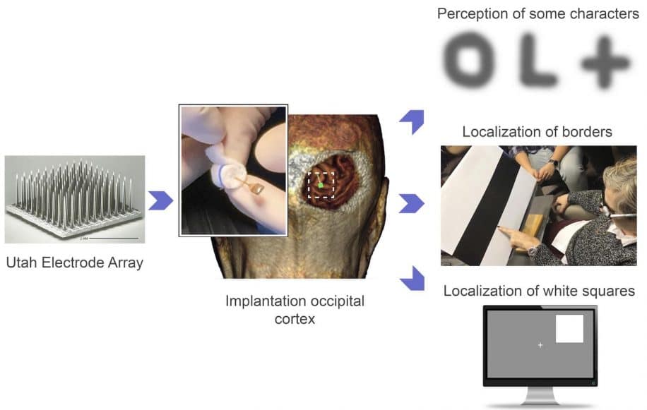 Brain implant allows blind to "see" through camera